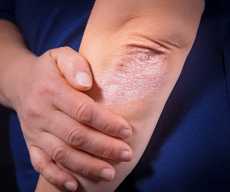 Last van huidklachten? - Infyzo